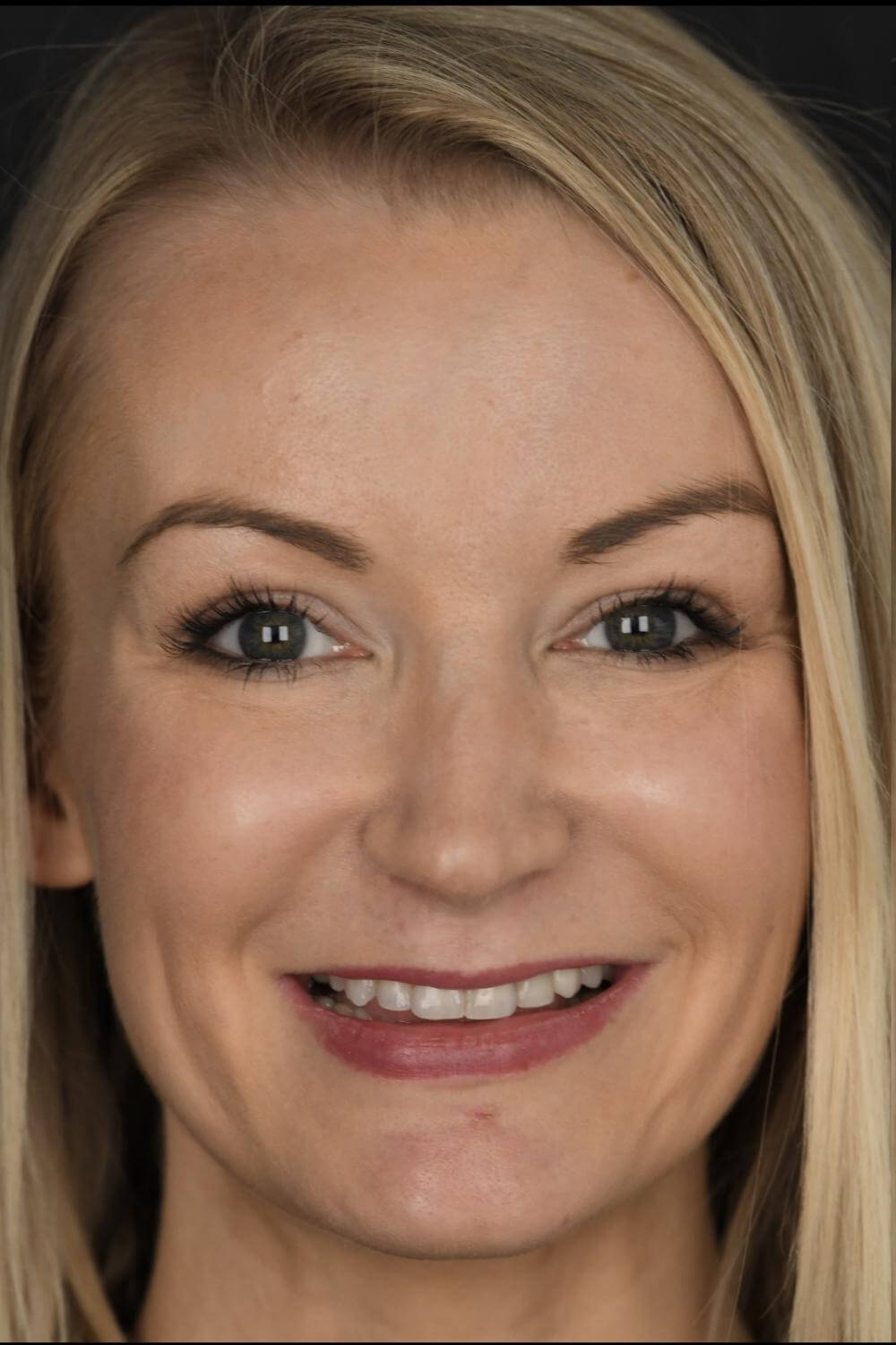 My Lip Lift + Veneers: Before and After Transformation