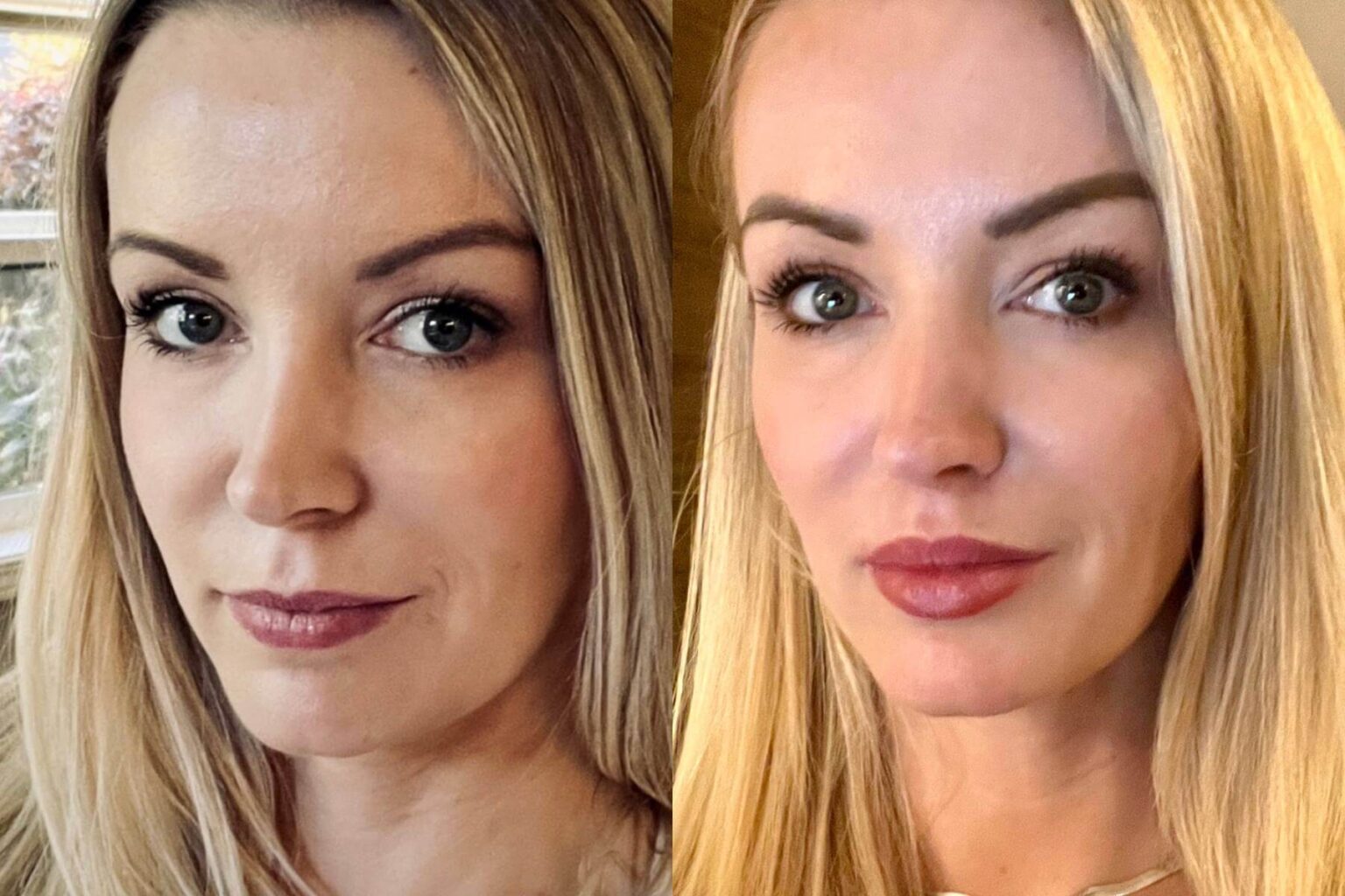 My Lip Lift + Veneers: Before and After Transformation