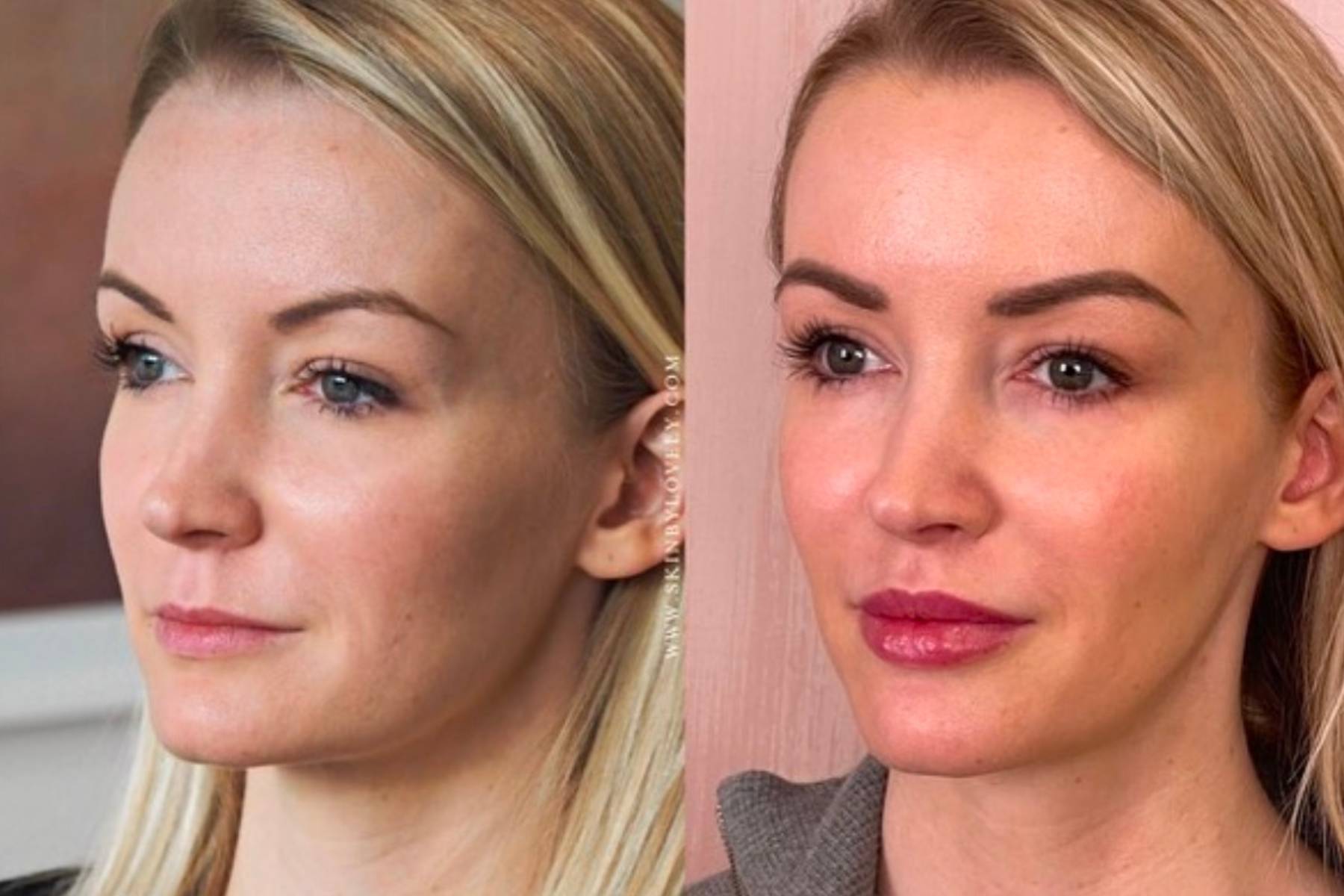 My Sculptra Before and After Photos: The Best Glow Up